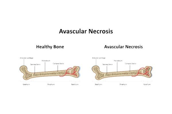 What is avascular necrosis? Dr.Vinil Shinde