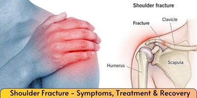 Shoulder Fracture: Symptoms, Causes, Risk Factors – IEYHQ