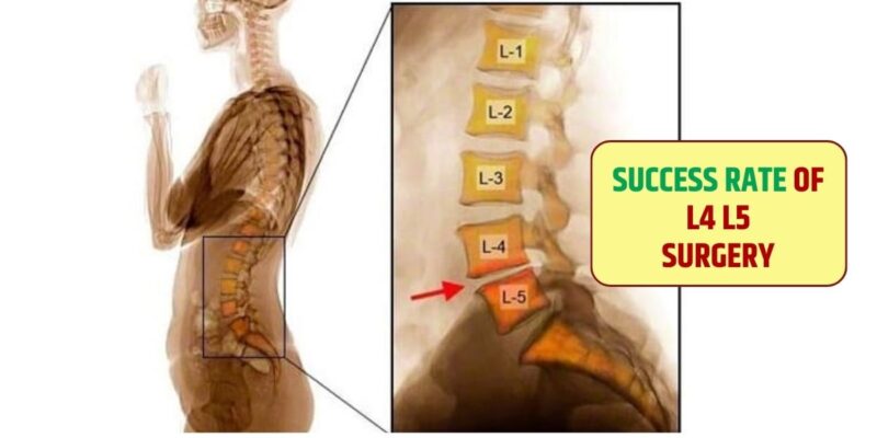 What is the Success Rate of L4 L5 Surgery? - Dr. Vinil Shinde