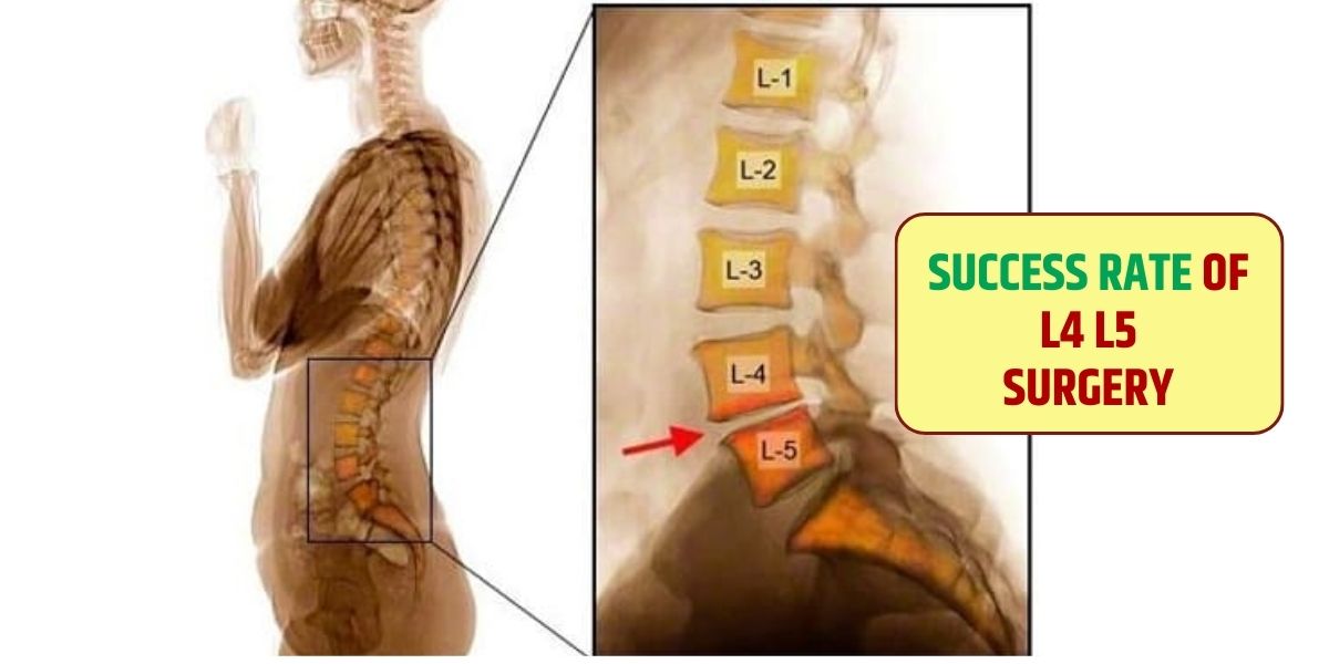 What is the Success Rate of L4 L5 Surgery? - Dr. Vinil Shinde